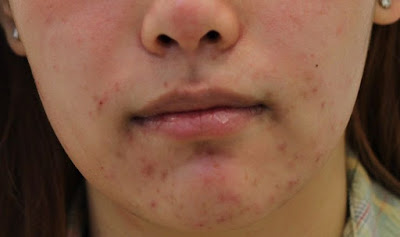 Causes and How to Get Rid Of Mouth Acne - BeautyHealthPlus