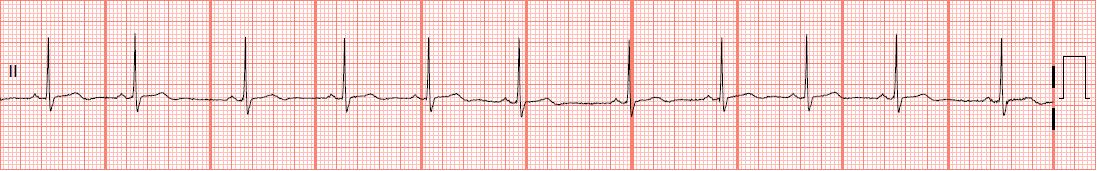 Basic ECG Rhythms