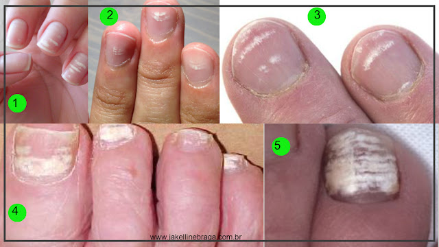 Blog de Podologia,Saúde e Etc.: Podologia: Manchas Brancas nas unhas ...