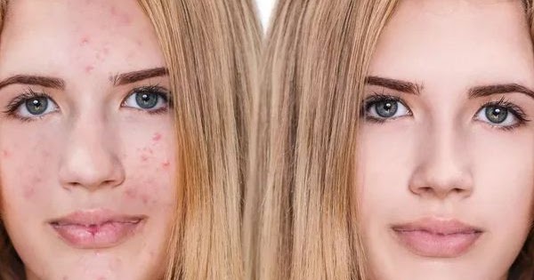 How to Get Rid of Acne Without Using Medication