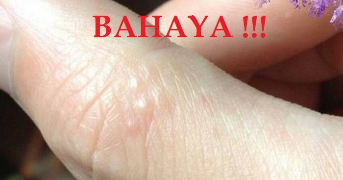 WASPADA.......!! JIKA ADA BINTIK SEPERTI INI DI JARIMU, SEGERA ...