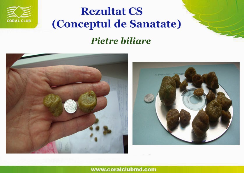 stil de viata unic.....: Litiaza biliara sar renala. Pietre la rinichi ...