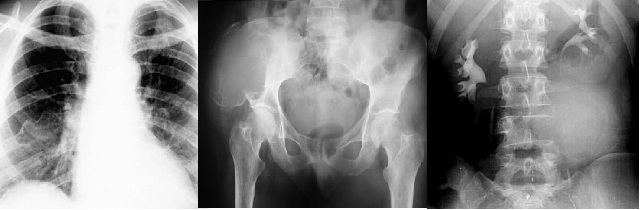 Dr Herry Setya Yudha Utama SpB. FInaCS. MHKes. ICS: Malignant Bone ...