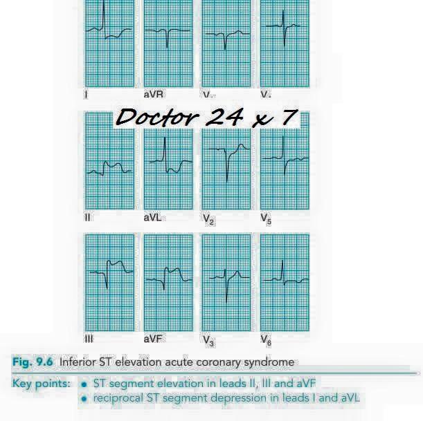 amudu: Easy way to learn ECG. Step by Step in a very easy way