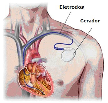 Marcapasso e os cuidados de enfermagem - Enfermagem