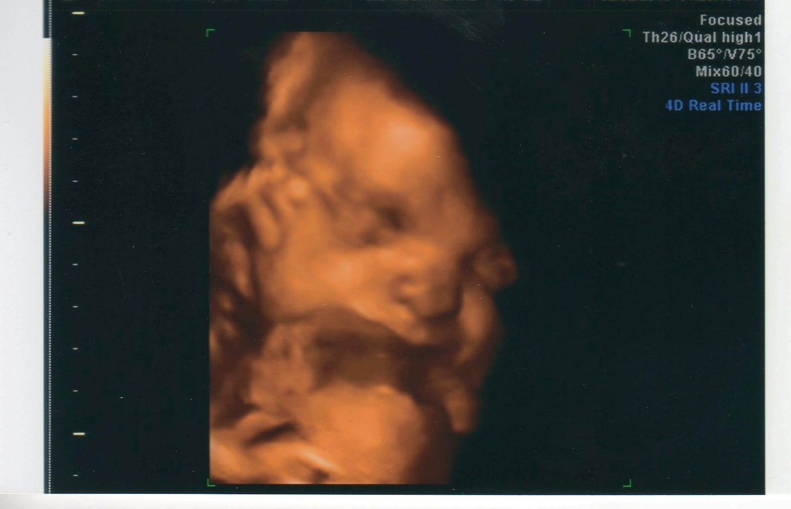 32 Weeks and 3D Ultrasound