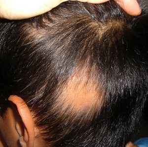 Sehat Itu Barokah: Cara Mengatasi Rambut Rontok Pada Anak