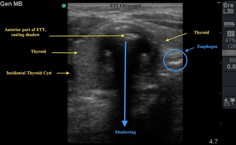 Ultrasound to Confirm Endotracheal Tube Placement ~ Ultrasound Cases Info