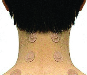 Pain Free Acupuncture Clinic: Magnet Therapy