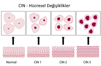 CIN 1, CIN 2, CIN 3
