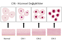 CIN 1, CIN 2, CIN 3
