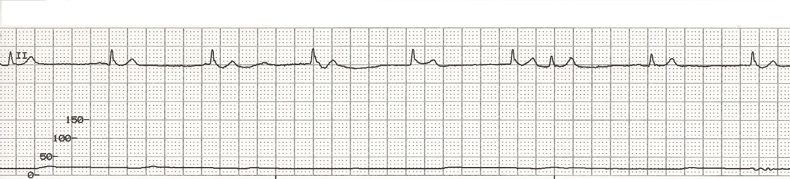 Various rhythms with arterial blood pressure waveform
