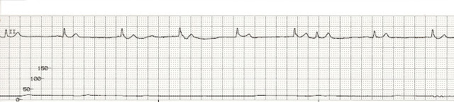 Various rhythms with arterial blood pressure waveform