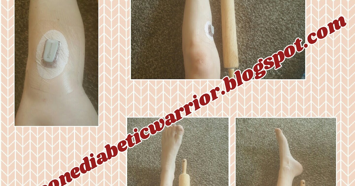 I am a Type 1 Diabetic Warrior: I got brave and put my Dexcom sensor on ...