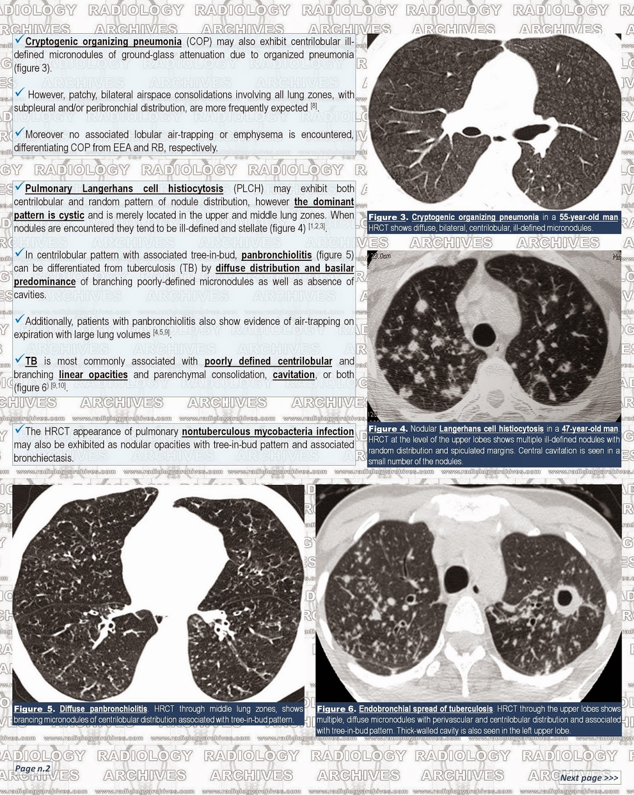 Radiology Archives: A guide to analyze Nodular Pattern in Interstitial ...
