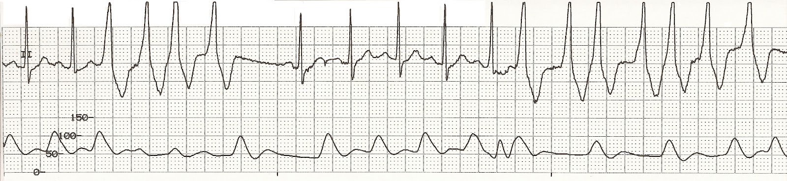EKG Rhythm Strip Quiz 45