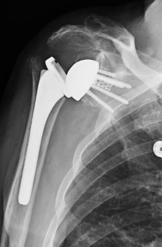 Shoulder and Elbow Surgery: Dislocation of reverse shoulder replacement ...