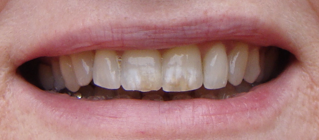 Braces at 56: Last adjustment! Incognito and Inspire Ice braces off at ...