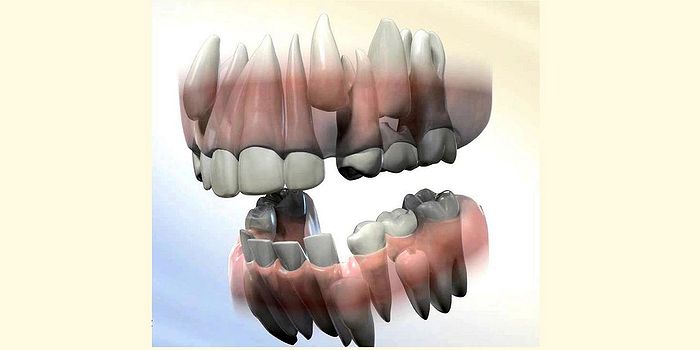 ORTHODONTICS : Serial extraction of primary teeth - OdontoVida