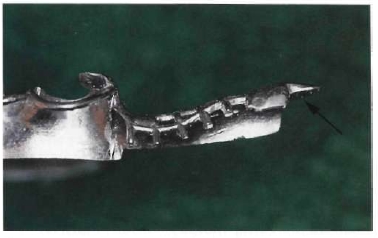 hiphoplife: Tissue Stops in RPD