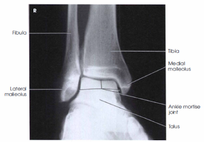 AP MORTISE PROJECTION - 15 TO 20 DEGREE MEDIAL ROTATION : ANKLE ...