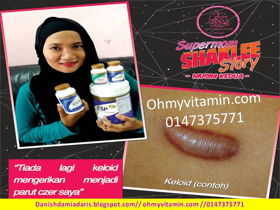 3D health beauty supplement: CARA HILANGKANG PARUT HIDUP KELOID SECARA ...
