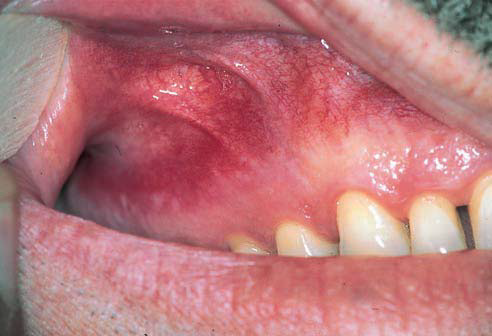 Red Lesions of the Oral Mucosa-Differential Diagnosis, Clinical ...