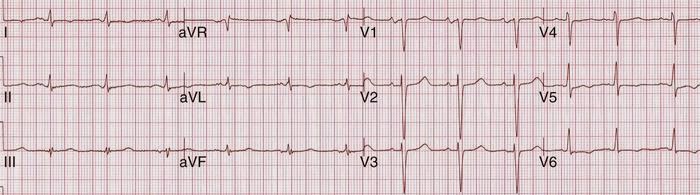 INFARK MIOCARDIUM - Mydokterhewan