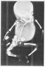 Beyond the Cross: Brittle Bone Disease