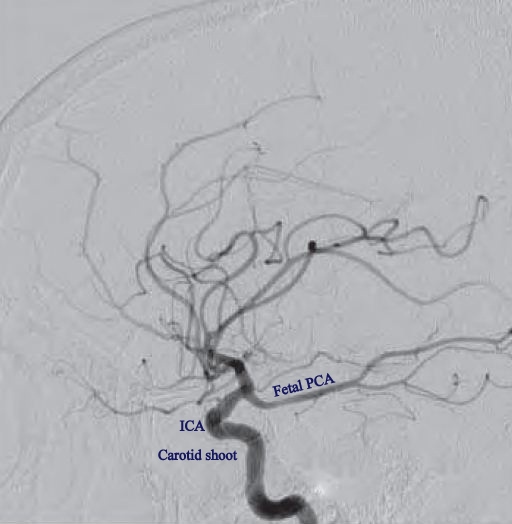 Dr Balaji Anvekar FRCR: Carotid - Vertebrobasilar Anastomoses