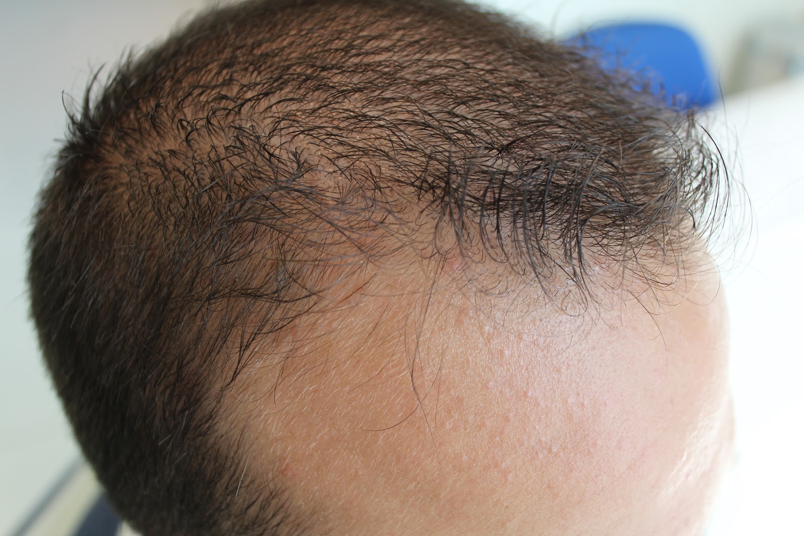 Laser for hair Capellux