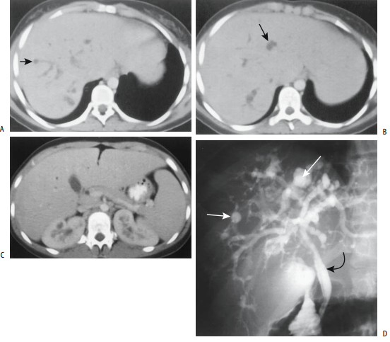 CT Abdoment With Contrast for Caroli’s Disease - Radiology Imaging