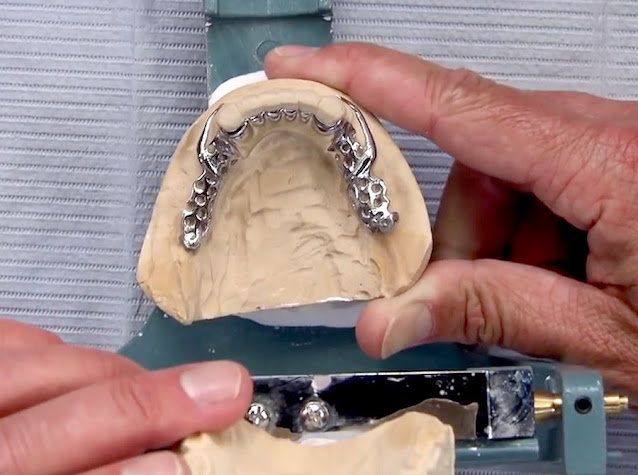 PARTIAL DENTURE: Achieving Retention and Support in a "Slippery Slope" Case