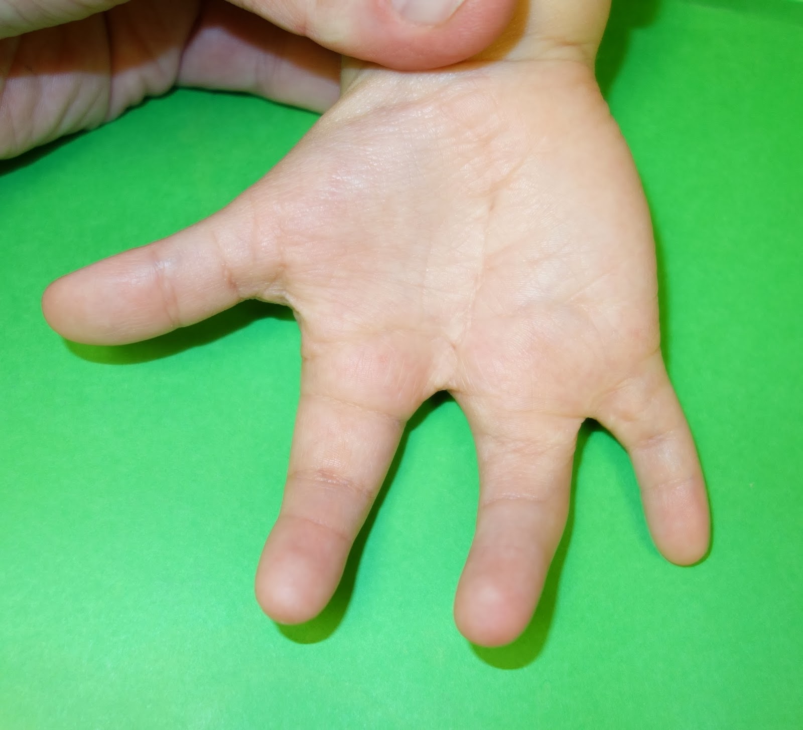 Challenges with Cleft Hand Reconstruction | Congenital Hand and Arm ...