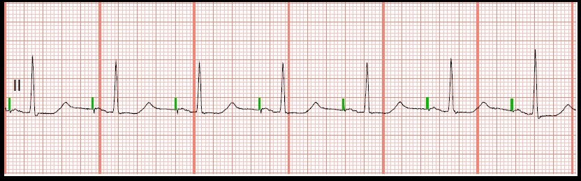 EKG Rhythm Strip Quiz 145