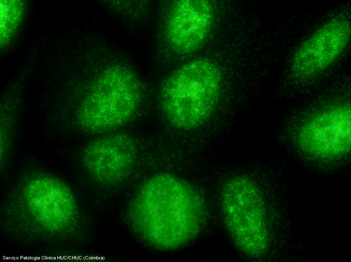 Anticorpos anti - SSA (Ro) e anti - SSB (La)