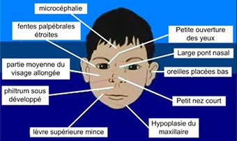 Le Cerveau de l'Enfant et de l'Adolescent: Effets de l'Alcool sur le ...