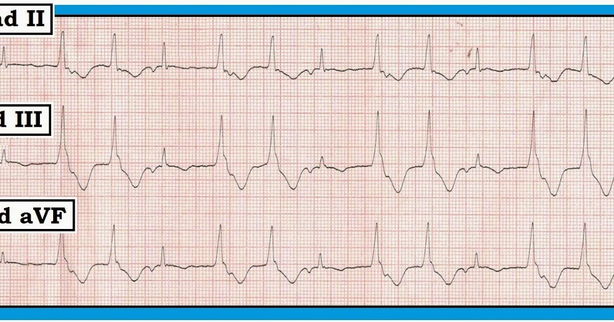 ECG Interpretation: ECG Blog #107 (PVCs - Couplets - Echo Beats - AIVR ...