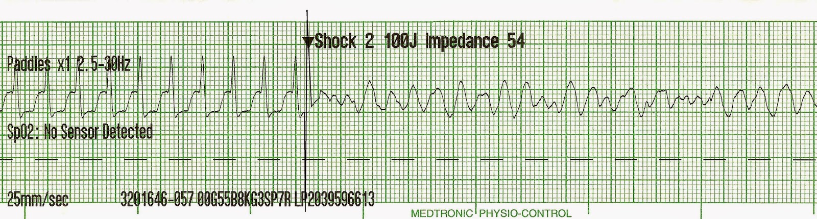 EKG Rhythm Quiz 260