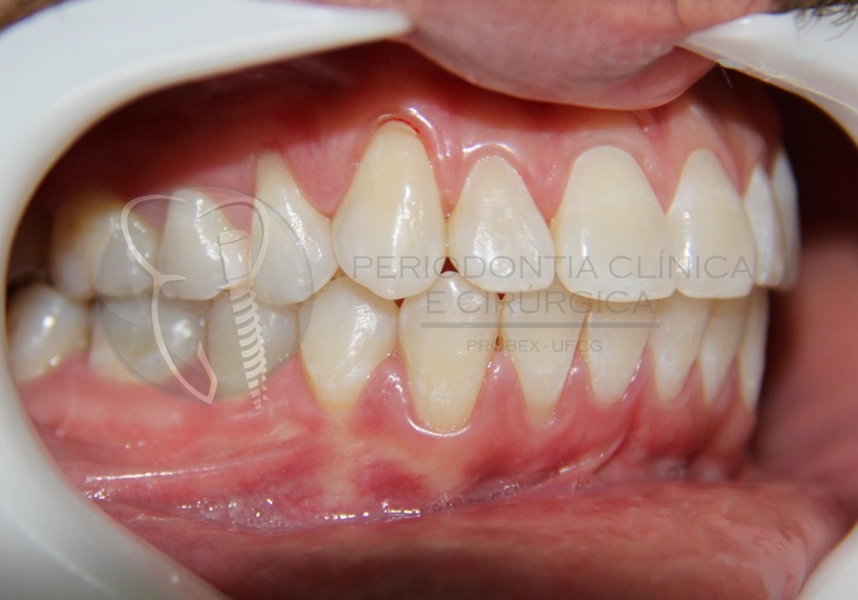 Retalho reposicionado coronalmente para recobrimento radicular: relato ...