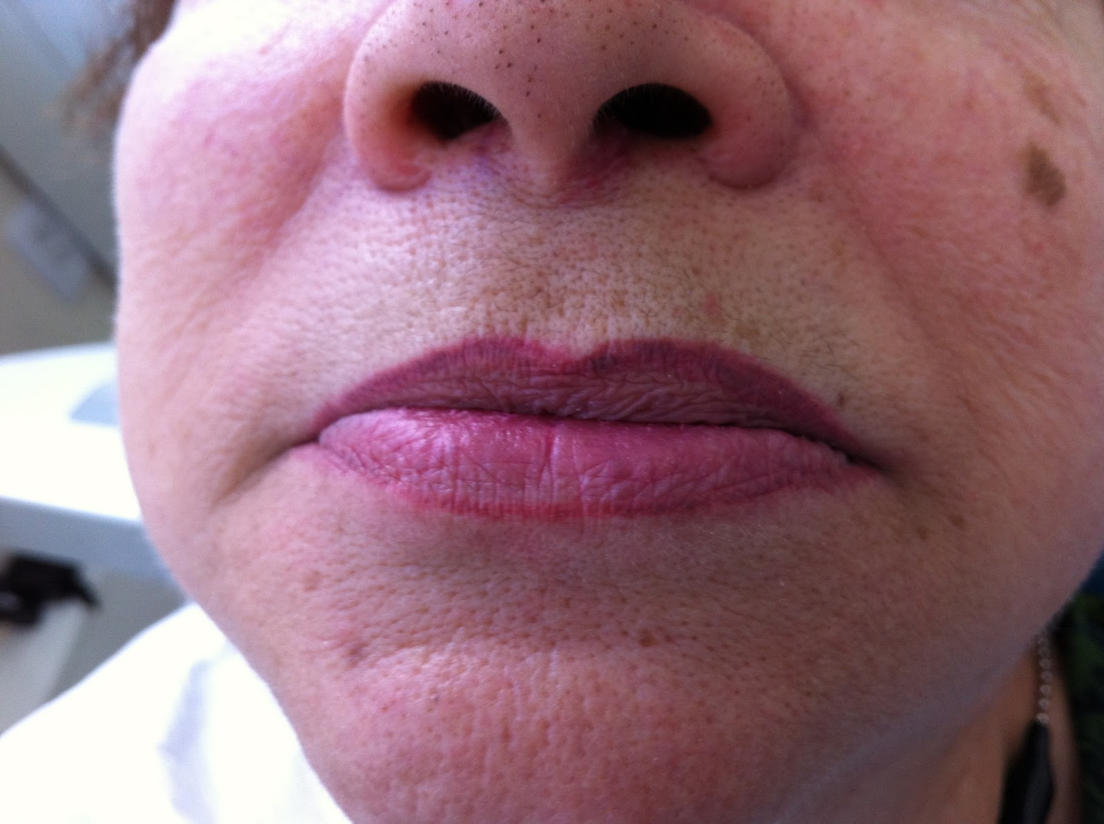 Clínica Ubiratã de Oliveira: Prótese Total sobre Implantes