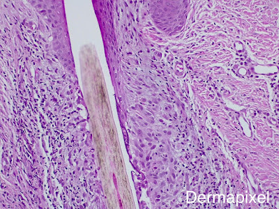 Dermapixel: abril 2018