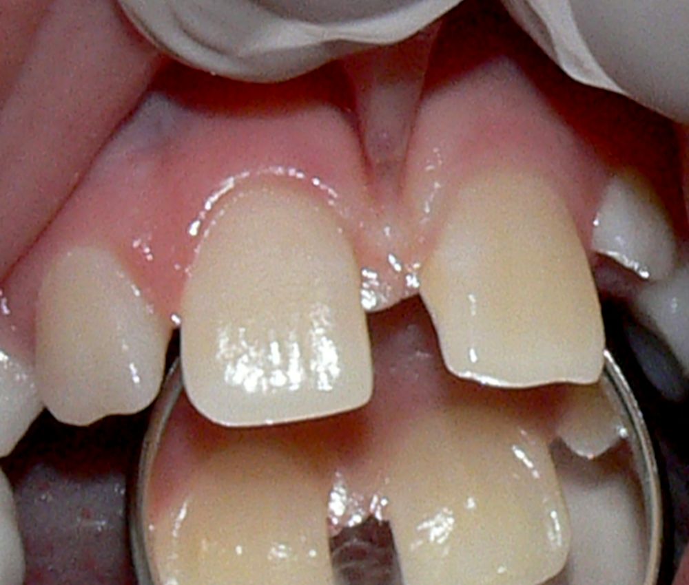 Etiology and treatment of midline DIASTEMA | Directorio Odontológico