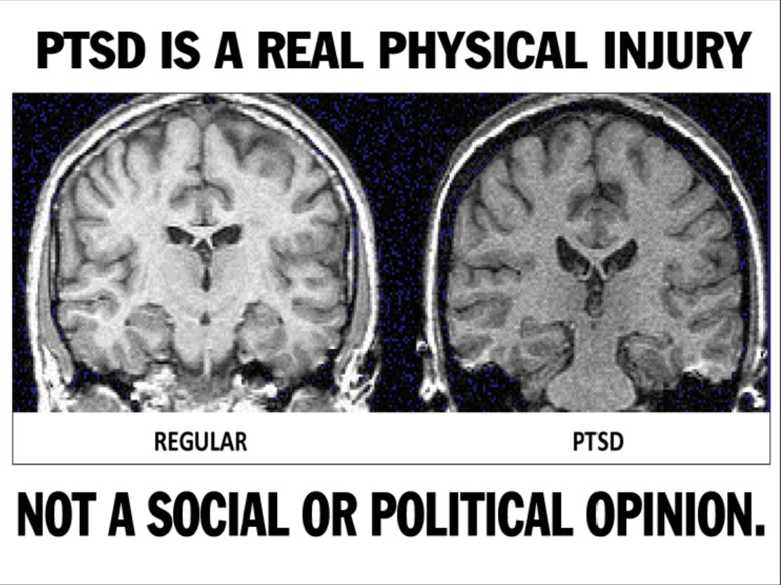 PTSD News: PTSD? PTS? PTSI?