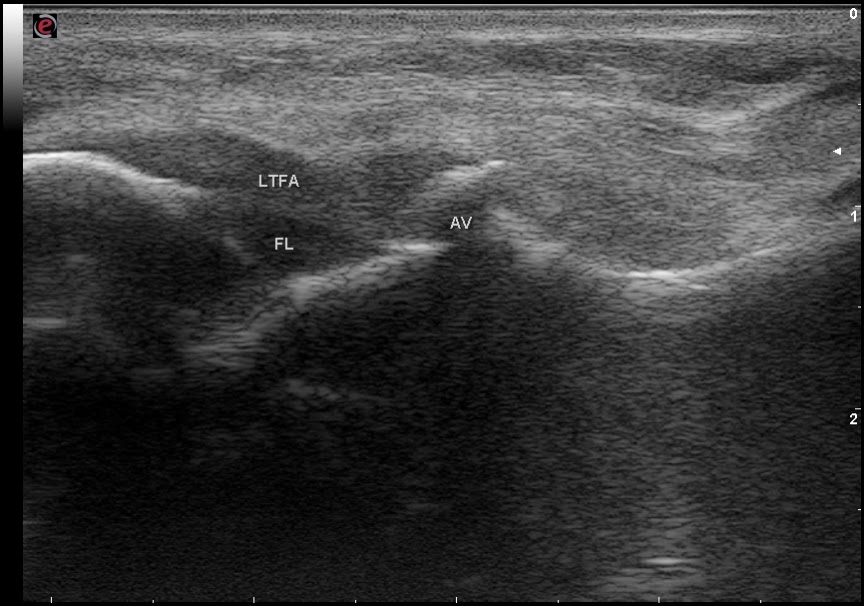 Avulsion fracture of the talar attachment of the anterior talofibular ...