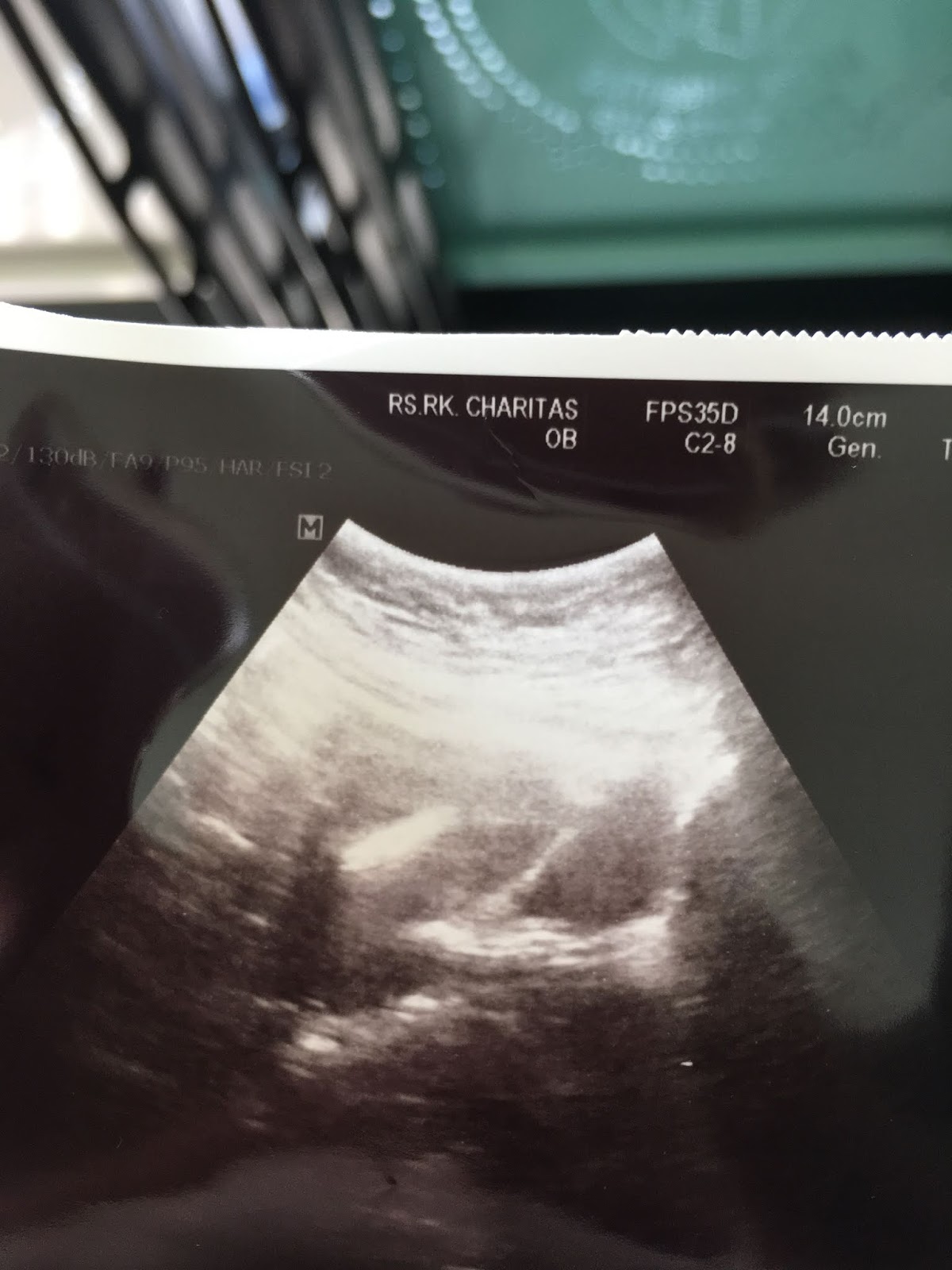 Story of My Journey: Pengalaman Pasang KB IUD