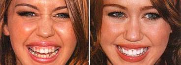 Miley Cyrus Plastic Surgery