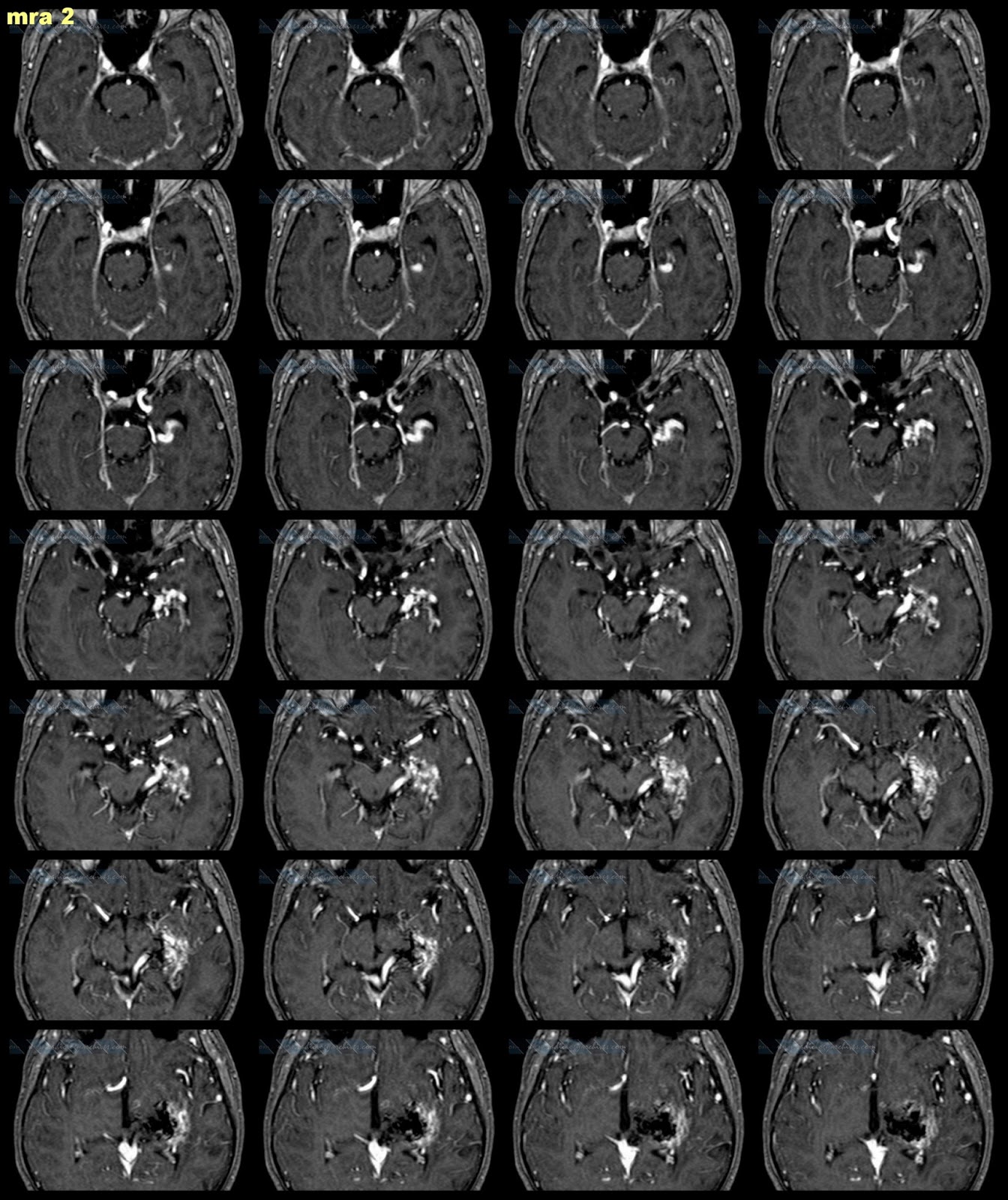 Radiology Archives: Αρτηριοφλεβώδης Δυσπλασία Εγκεφάλου (Spetzler ...