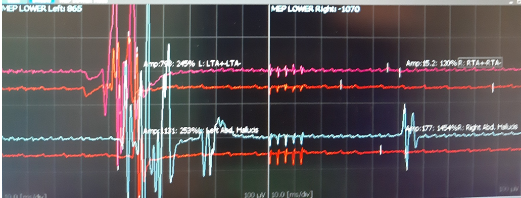 Neurophysiology Plus Iceland: D wave IONM in Iceland. Third case ...