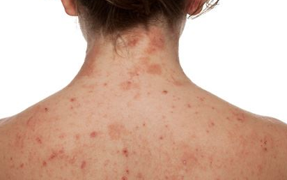 Tipos de dermatitis. Terapias Dermatológicas.